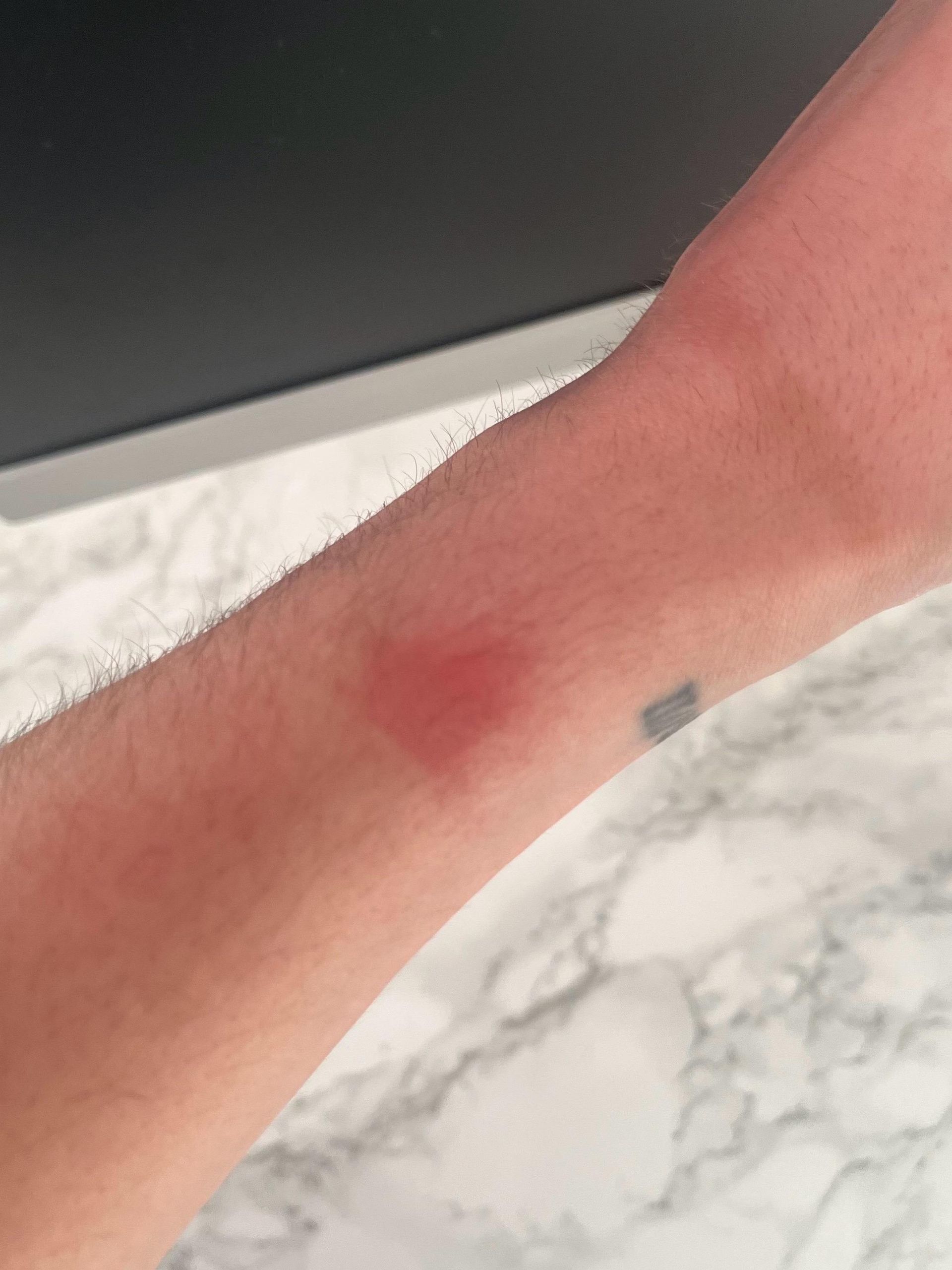 Anyone else get these type of marks or rashes from certain watch straps ...