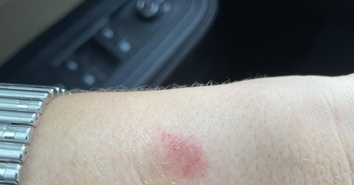 Rashes under my watch | WatchCrunch