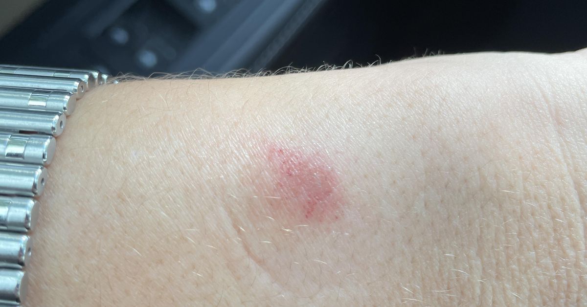 Rashes under my watch | WatchCrunch