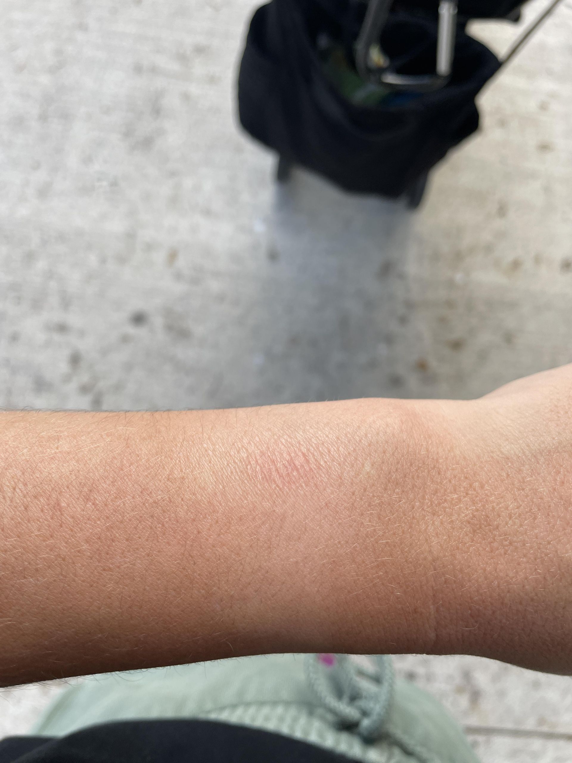 Rashes under my watch | WatchCrunch